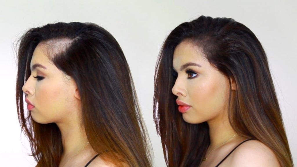 Postpartum Hair Loss Toronto Trichology Centre Hair Loss Clinic Prp